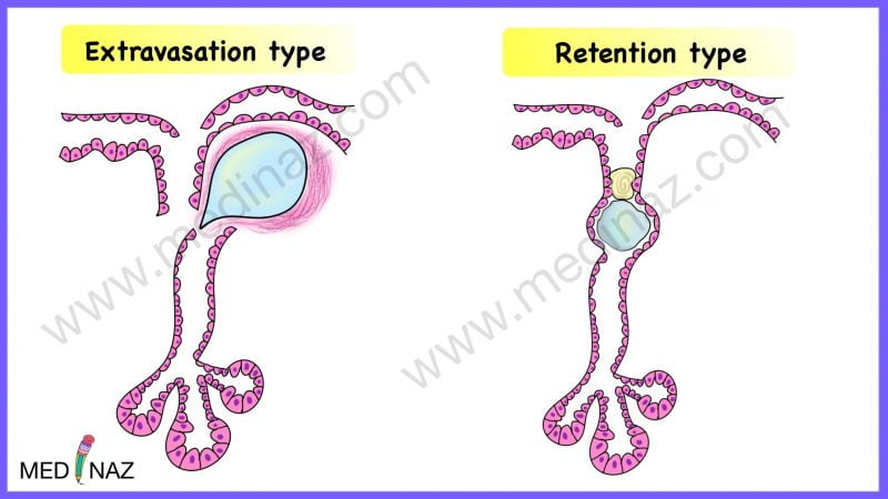 Oral Mucocele: Illustrated High Yield Dental Notes - Medinaz