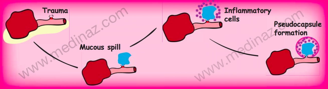 Oral Mucocele: Illustrated High Yield Dental Notes - Medinaz