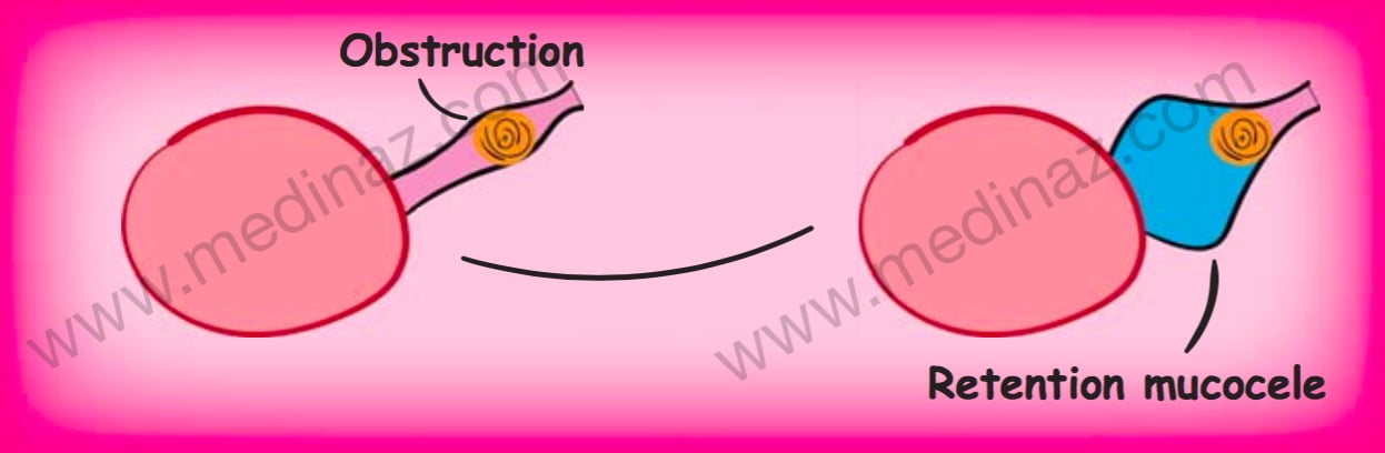 Oral Mucocele: Illustrated High Yield Dental Notes - Medinaz