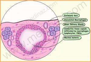 Oral Mucocele: Illustrated High Yield Dental Notes - Medinaz