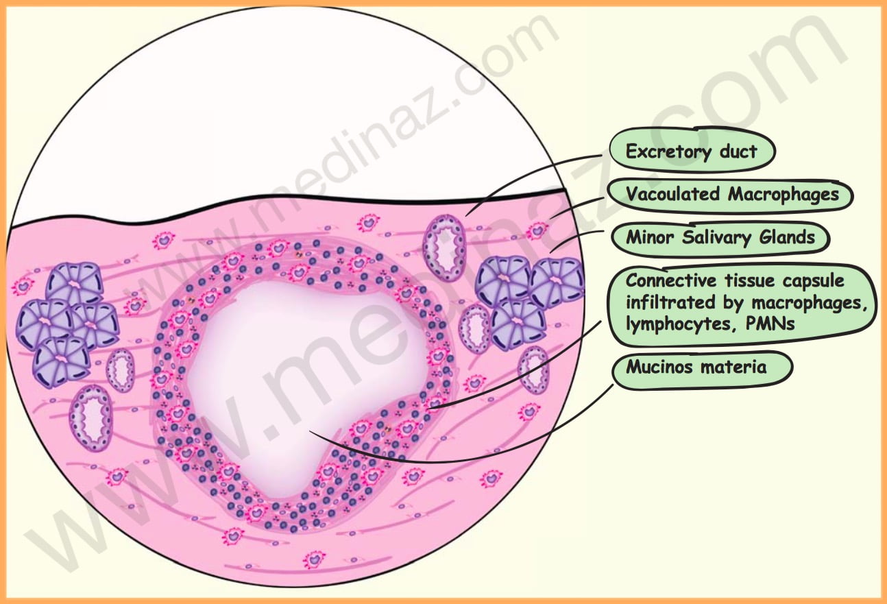 Oral Mucocele: Illustrated High Yield Dental Notes - Medinaz