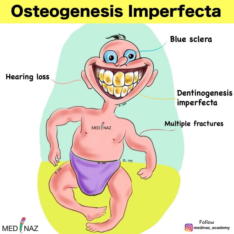 Osteogenesis Imperfecta - Medinaz HighYield Notes