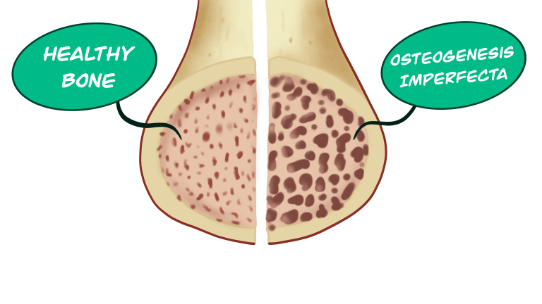 Osteogenesis Imperfecta - Medinaz HighYield Notes