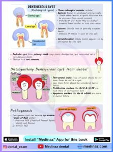 Dentigerous Cyst Oral Pathology Notes - Medinaz Blog