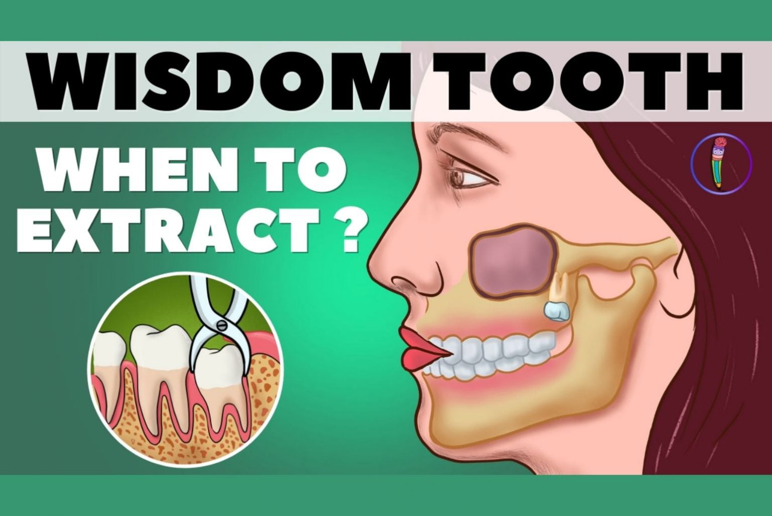 Wisdom Teeth Removal - Know when to pull them out - Medinaz Blog