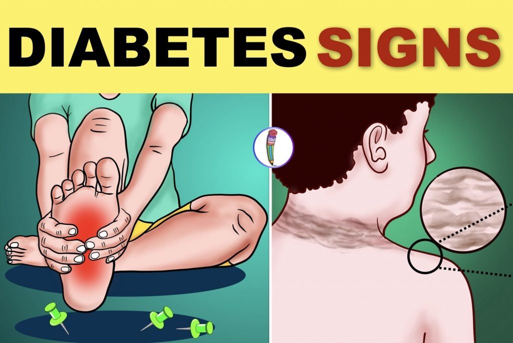 Diabetes Signs and Symptoms - All You Need to Know