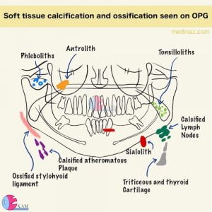 Soft tissue calcification in Head & Neck region - Classification