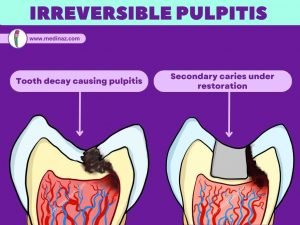 Irreversible Pulpitis: HY Dental Notes - Medinaz Blog