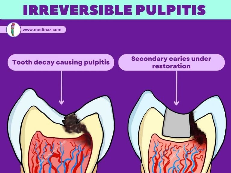 Irreversible Pulpitis: HY Dental Notes - Medinaz Blog