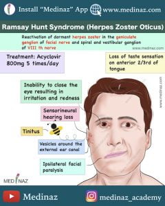 Ramsay Hunt Syndrome: HY Medicine Notes