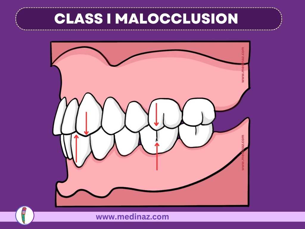 ANGLE S CLASSIFICATION MALOCCLUSION Dental Notes ANGLE S CLASSIFICATION MALOCCLUSION Dental Notes