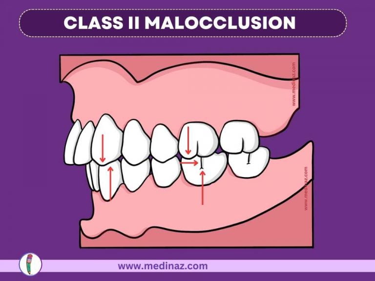 ANGLE’S CLASSIFICATION MALOCCLUSION - Dental Notes