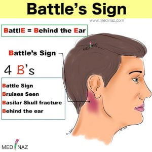 Battle's Sign USMLE Notes