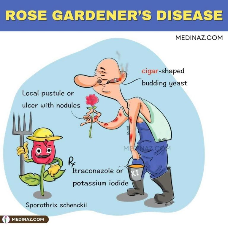 Sporotrichosis USMLE Notes