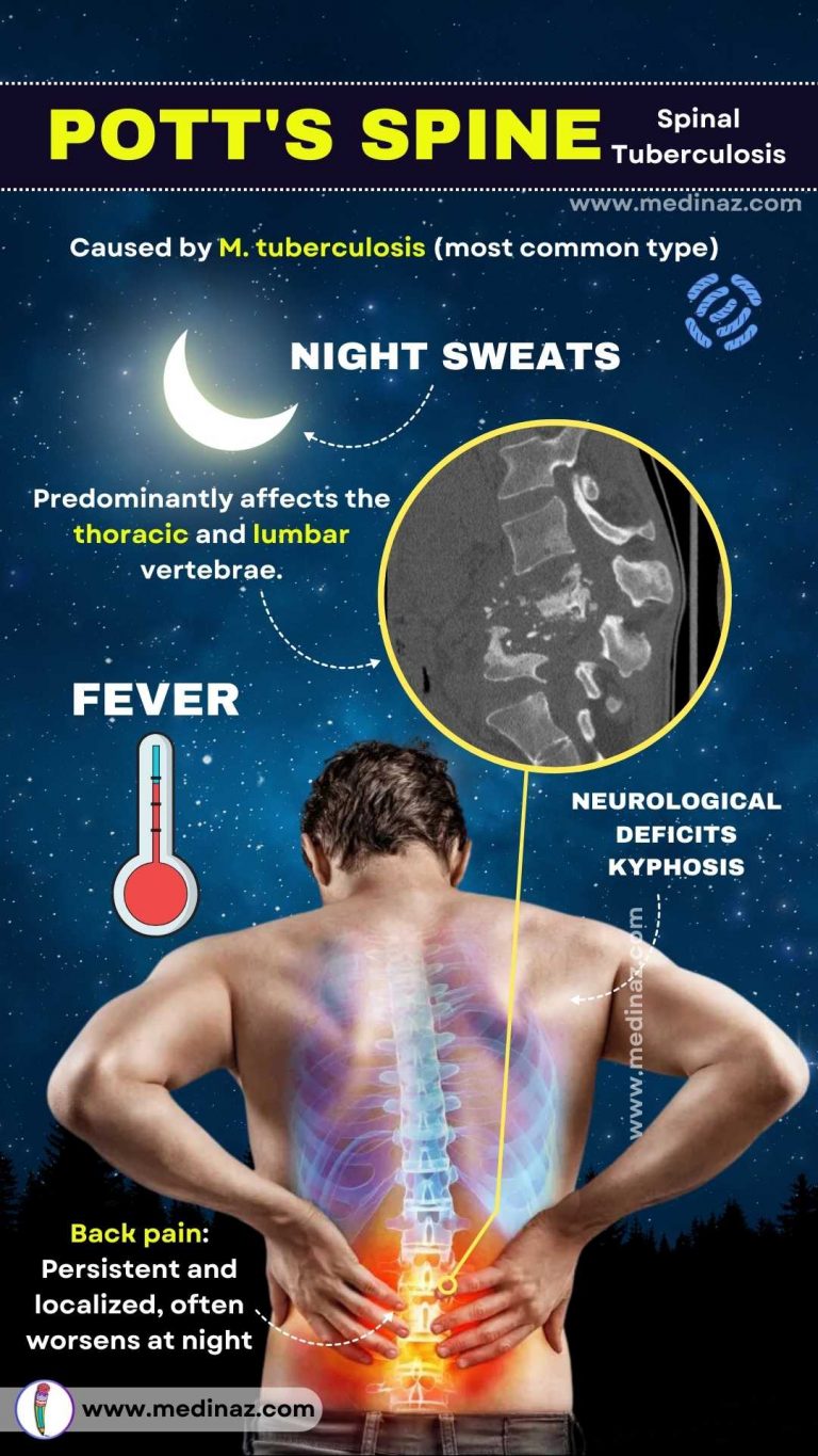 Spinal Tuberculosis USMLE Notes - Medinaz Blog
