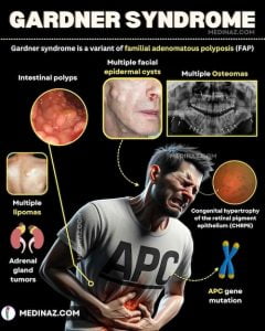 Gardner's Syndrome USMLE Notes