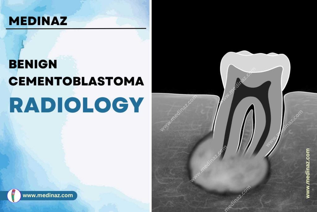 Benign Cementoblastoma Radiology: Dental Notes