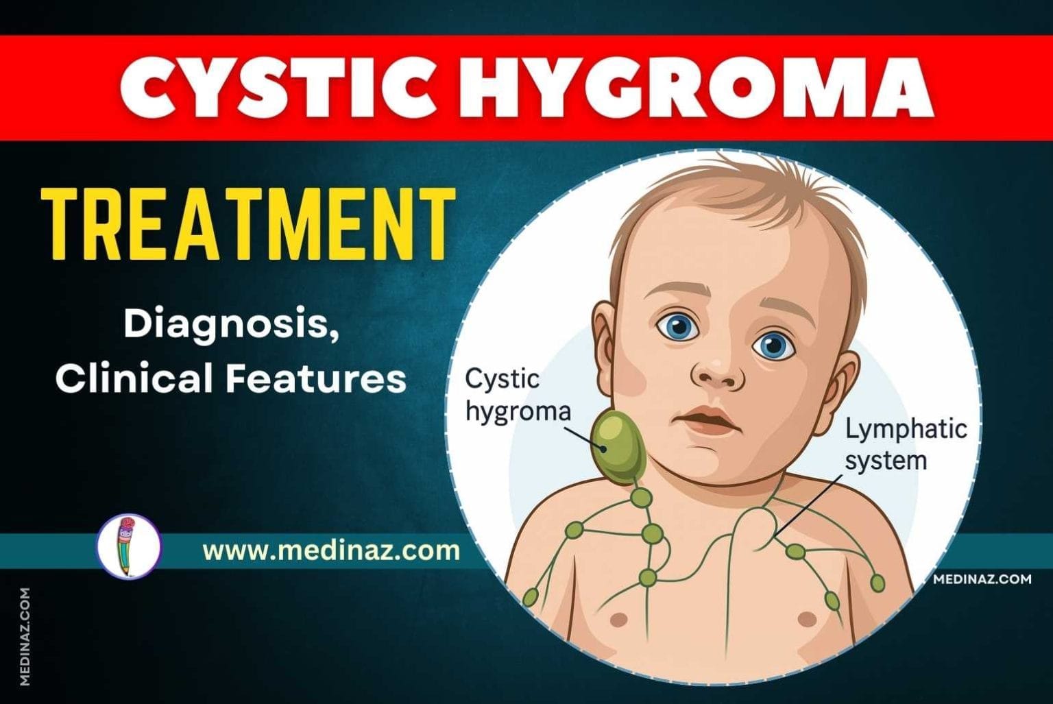 Cystic Hygroma Treatment - All You Need to Know
